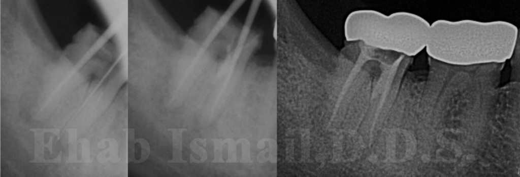 Retrieval or bypassing of broken instruments/files. - SoCal Root Canal