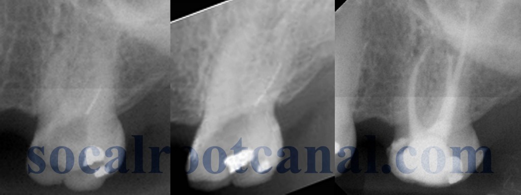 Retrieval or bypassing of broken instruments/files. - SoCal Root Canal