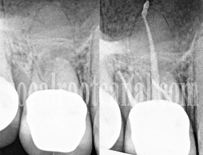 Calcified canals. - SoCal Root Canal